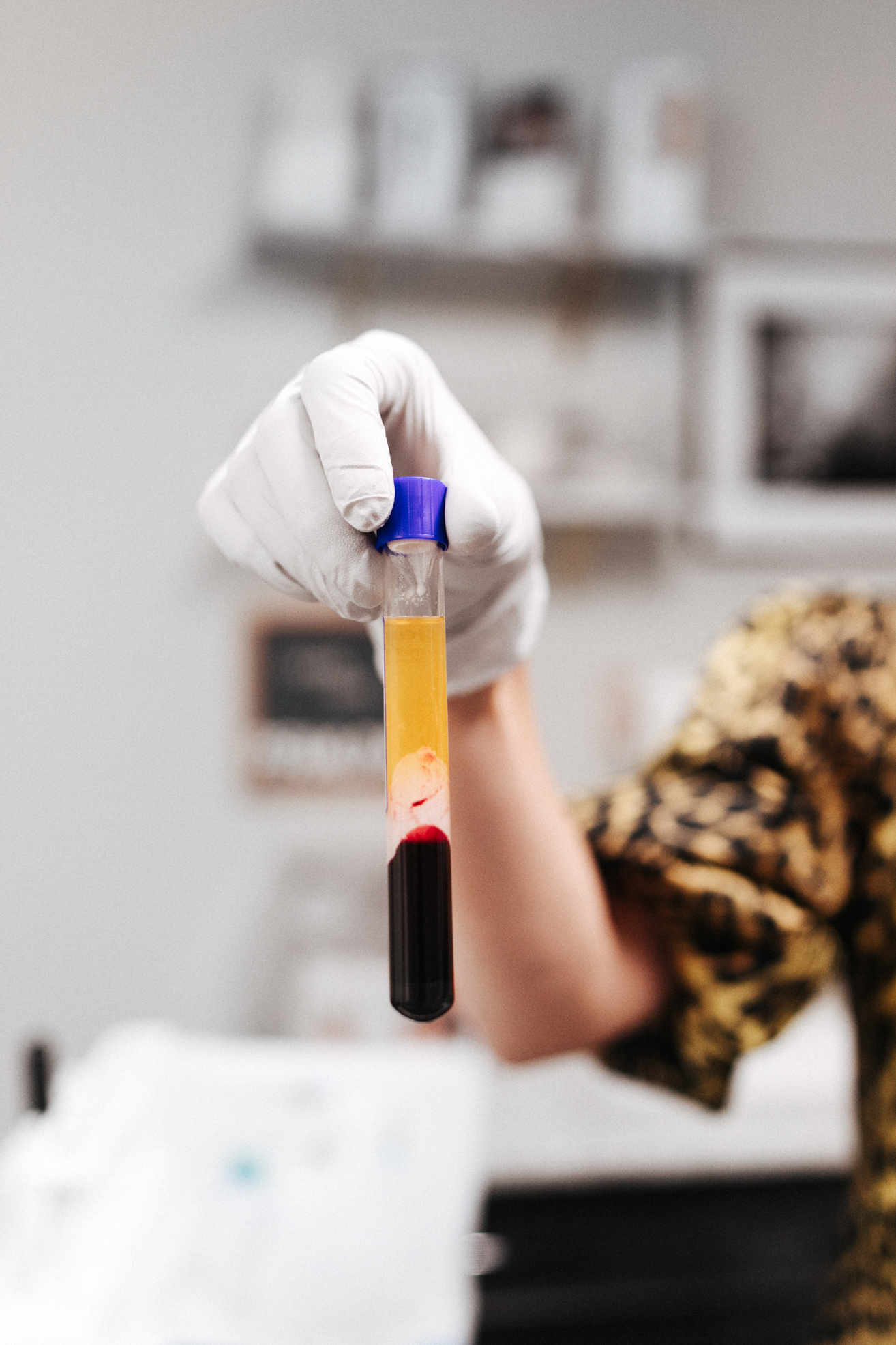 PRP AquaGold Treatment & What Are The Benefits of PRP Treatments?